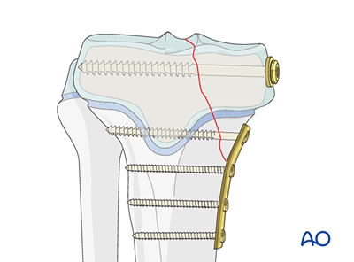 Plating principles in pediatric fracture care
