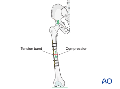 Tension band principles