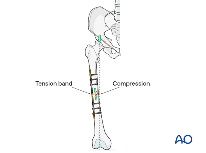 Tension band principles