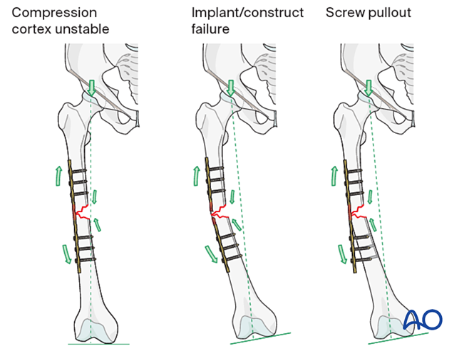 Tension band principles