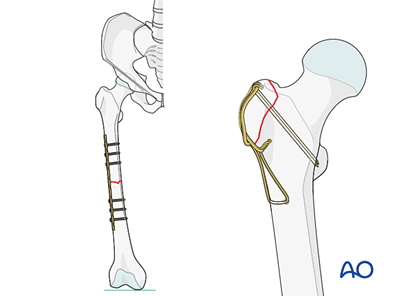 Tension band principles