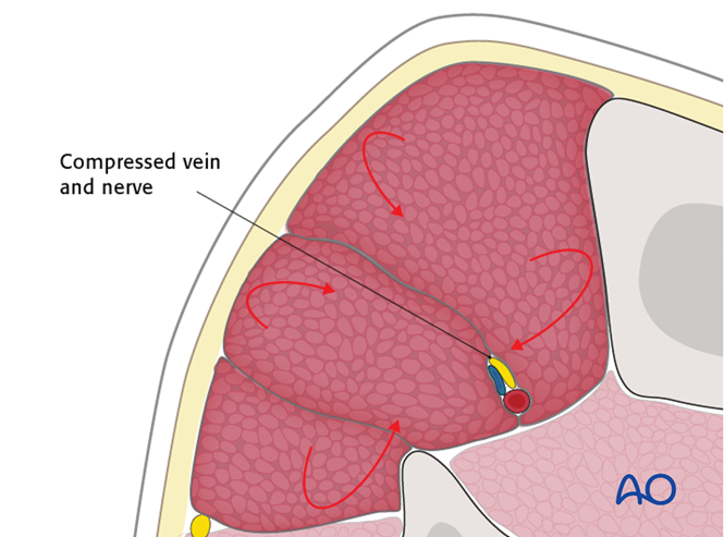 Compartment syndrome