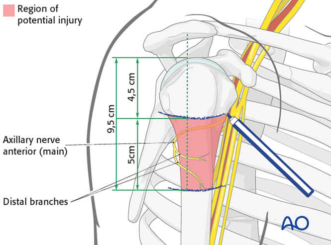 Transdeltoid Lateral Approach To The Proximal Humerus