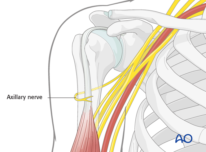 Transdeltoid lateral approach to the proximal humerus