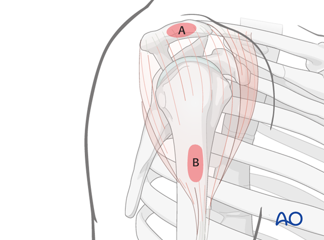 Transdeltoid lateral approach to the proximal humerus