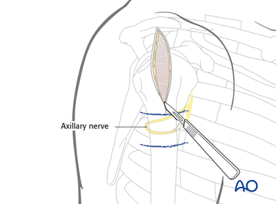 Transdeltoid lateral approach to the proximal humerus