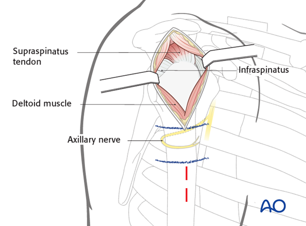 Transdeltoid Lateral Approach To The Proximal Humerus