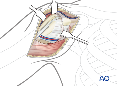 Hemiarthroplasty for Extraarticular 3-part, surgical neck and ...