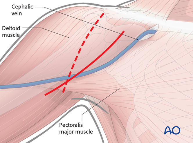 Deltopectoral approach to the proximal humerus