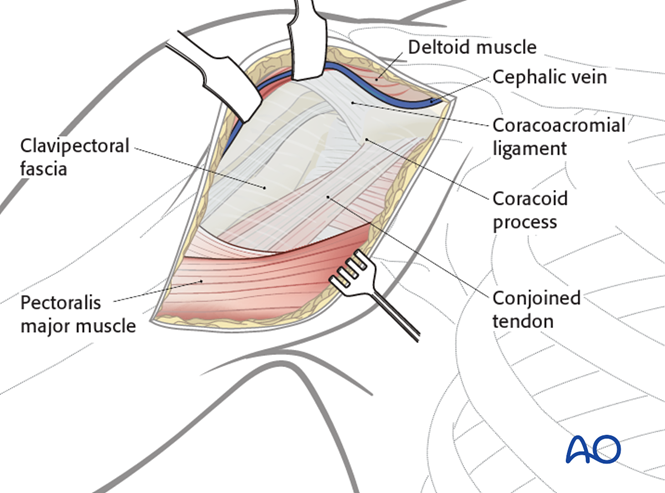 Deltopectoral approach to the proximal humerus