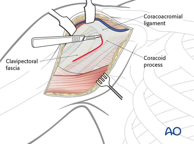 Deltopectoral approach to the proximal humerus
