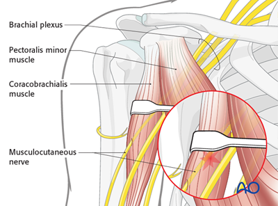 Deltopectoral approach to the proximal humerus