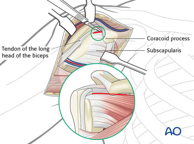 Deltopectoral approach to the proximal humerus