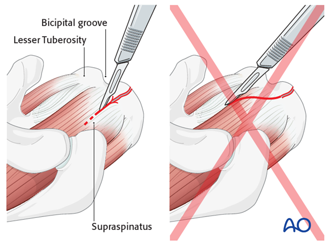 Deltopectoral approach to the proximal humerus