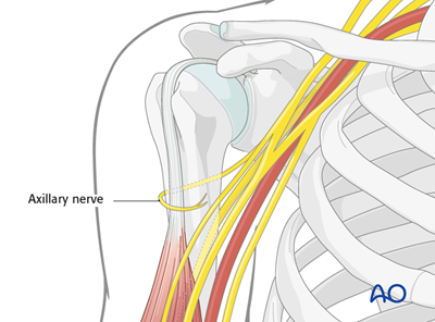 Anterolateral approach to the proximal humerus