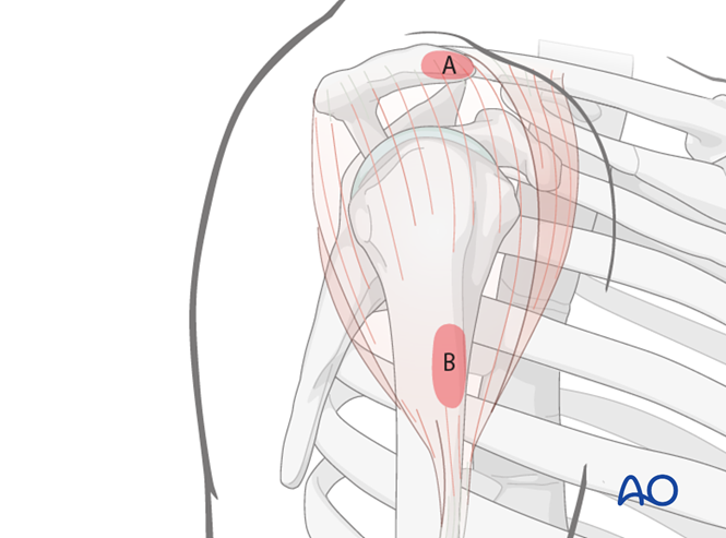 Anterolateral approach to the proximal humerus