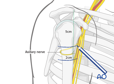 Anterolateral approach to the proximal humerus