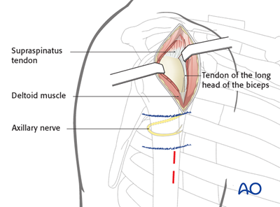 Anterolateral approach to the proximal humerus