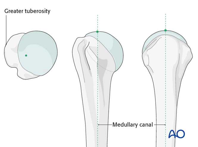 Anterolateral approach to the proximal humerus