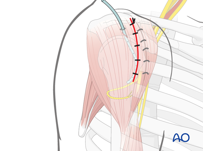Anterolateral approach to the proximal humerus