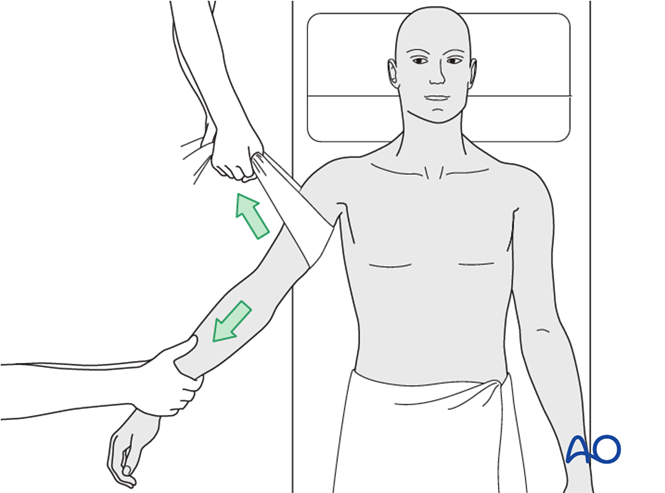 ORIF - Screw or suture fixation for Extraarticular 2-part, tuberosity ...