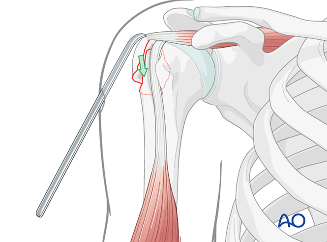 MIO - Screw fixation for Extraarticular 2-part, greater tuberosity ...