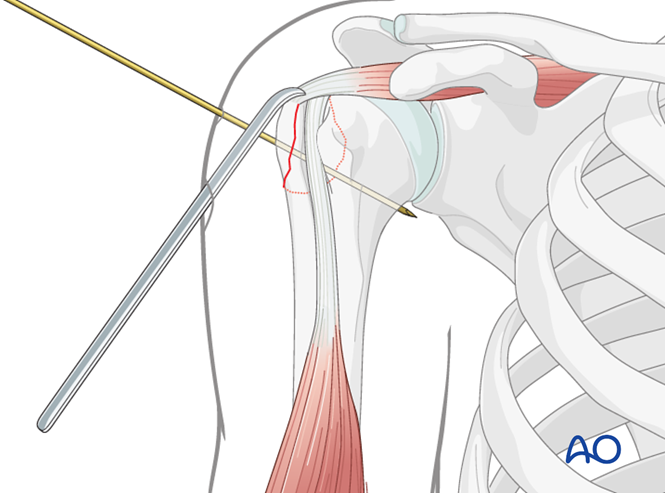 MIO - Screw fixation for Extraarticular 2-part, greater tuberosity ...