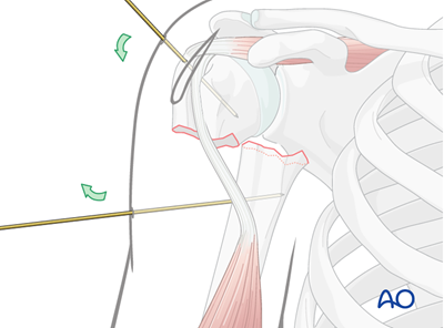 MIO - Plate fixation for Extraarticular 2-part, surgical neck, no impaction