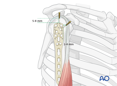 MIO - Plate fixation for 4-Part, slight displacement, varus malalignment