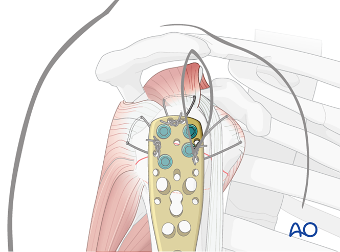 MIO - Plate fixation for Extraarticular 2-part, surgical neck, impaction