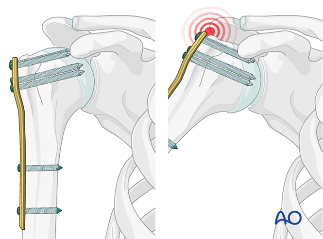 MIO - Plate fixation for 4-Part, slight displacement, varus malalignment