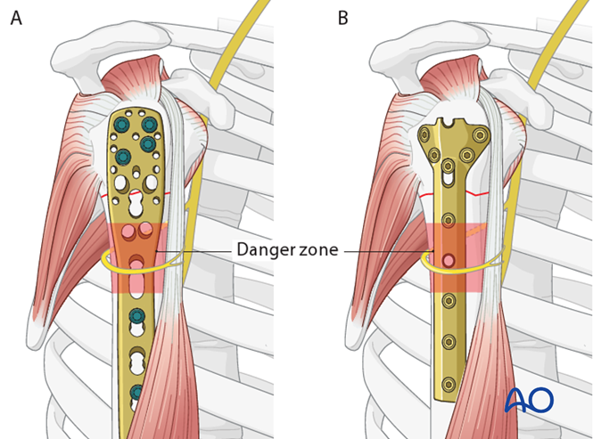 MIO - Plate fixation for Extraarticular 2-part, surgical neck, no impaction