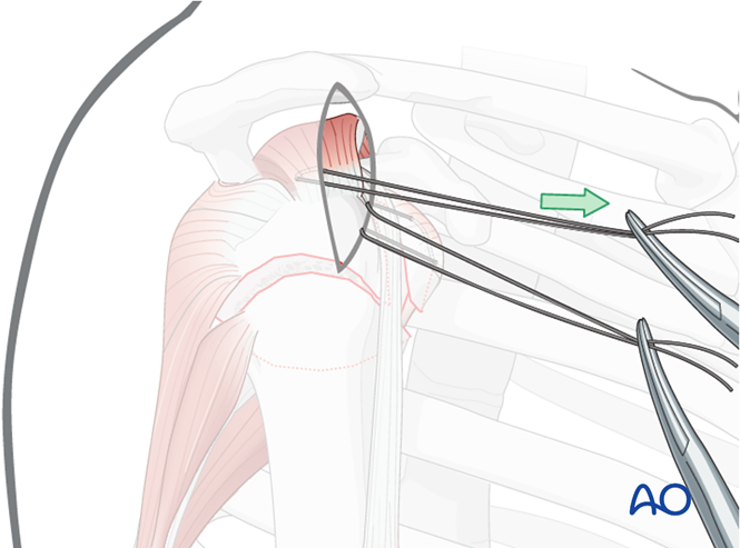 Limited open reduction and preliminary fixation of lesser tuberosity ...