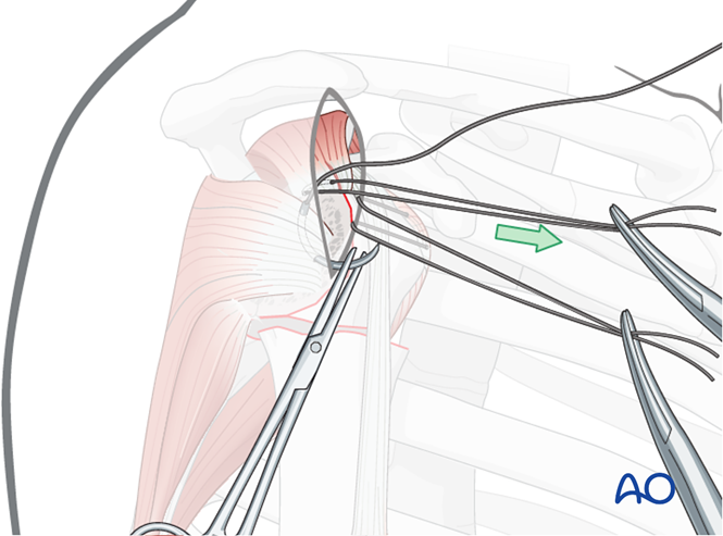 MIO - Plate fixation for Extraarticular 3-part, surgical neck and ...
