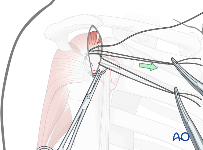 Limited open reduction and preliminary fixation of lesser tuberosity ...