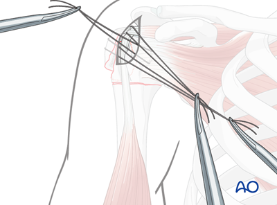 MIO - Plate fixation for Extraarticular 3-part, surgical neck and ...