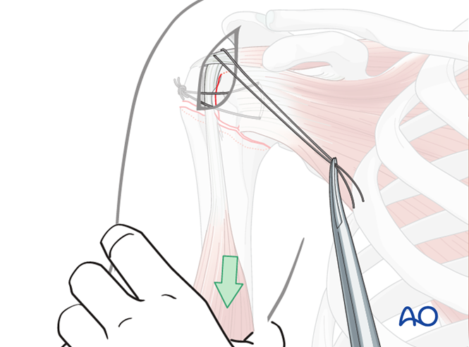 Limited open reduction and preliminary fixation of lesser tuberosity ...