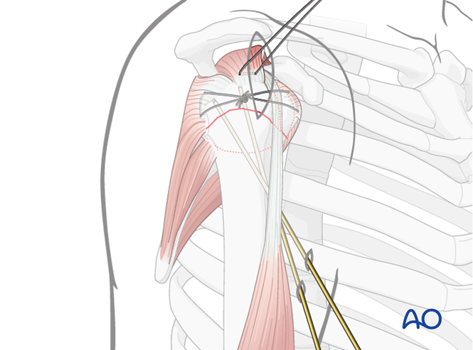 Limited open reduction and preliminary fixation of lesser tuberosity ...