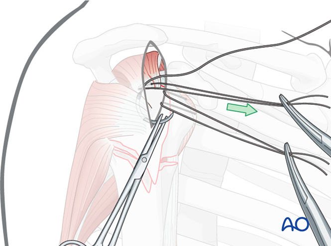 MIO - Plate fixation for Extraarticular 3-part, surgical neck and ...
