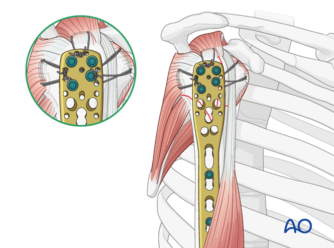 MIO - Plate fixation for Extraarticular 3-part, surgical neck and ...