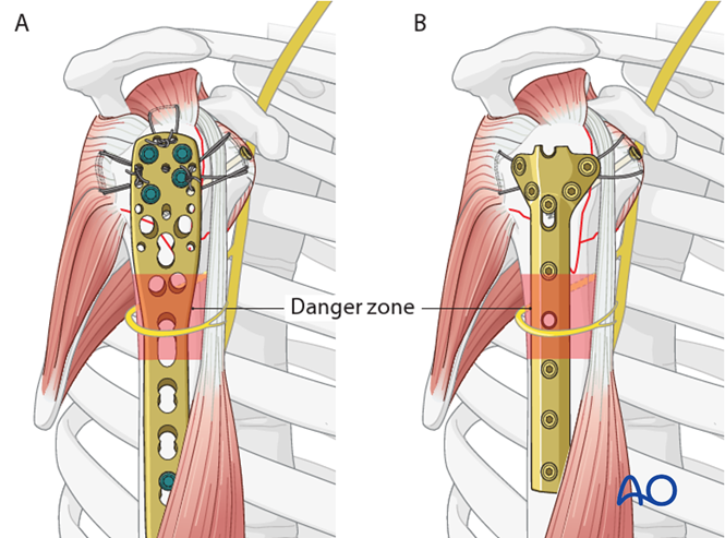MIO - Plate fixation for Extraarticular 3-part, surgical neck and ...