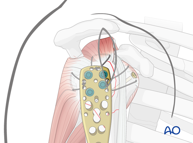 MIO - Plate fixation for 4-Part, slight displacement, varus malalignment