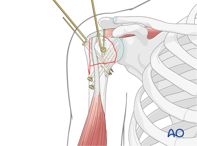 MIO - Screw fixation for 4-Part, slight displacement, valgus malalignment