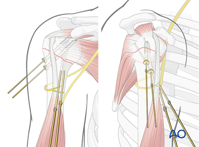 MIO - Screw fixation for Extraarticular 2-part, surgical neck, impaction