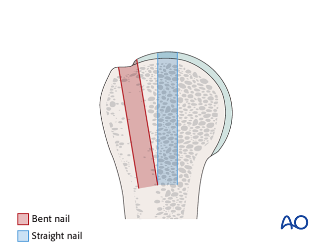 Nailing (straight nail) for Extraarticular 2-part, surgical neck, impaction