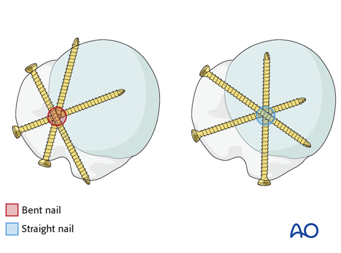 Nailing (straight nail) for Extraarticular 2-part, surgical neck, impaction