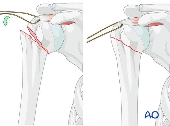 Nailing (straight nail) for Extraarticular 2-part, surgical neck, impaction