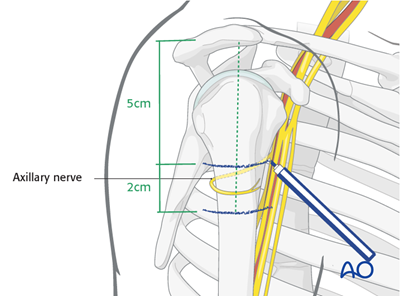 Nailing (straight nail) for Extraarticular 2-part, surgical neck, impaction