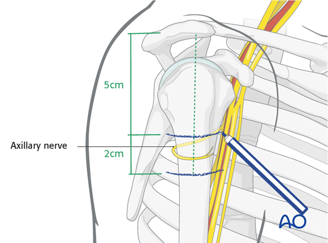 Nailing (straight nail) for Extraarticular 2-part, surgical neck, impaction