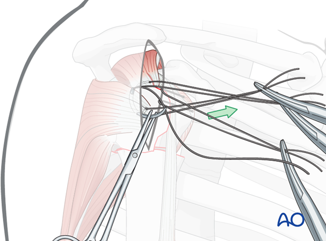 MIO - Plate fixation for Extraarticular 3-part, surgical neck and ...